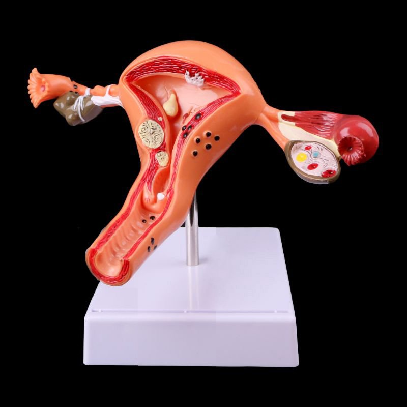 Human Women Female Uterus Ovary Pathology Model athological Uterus ...