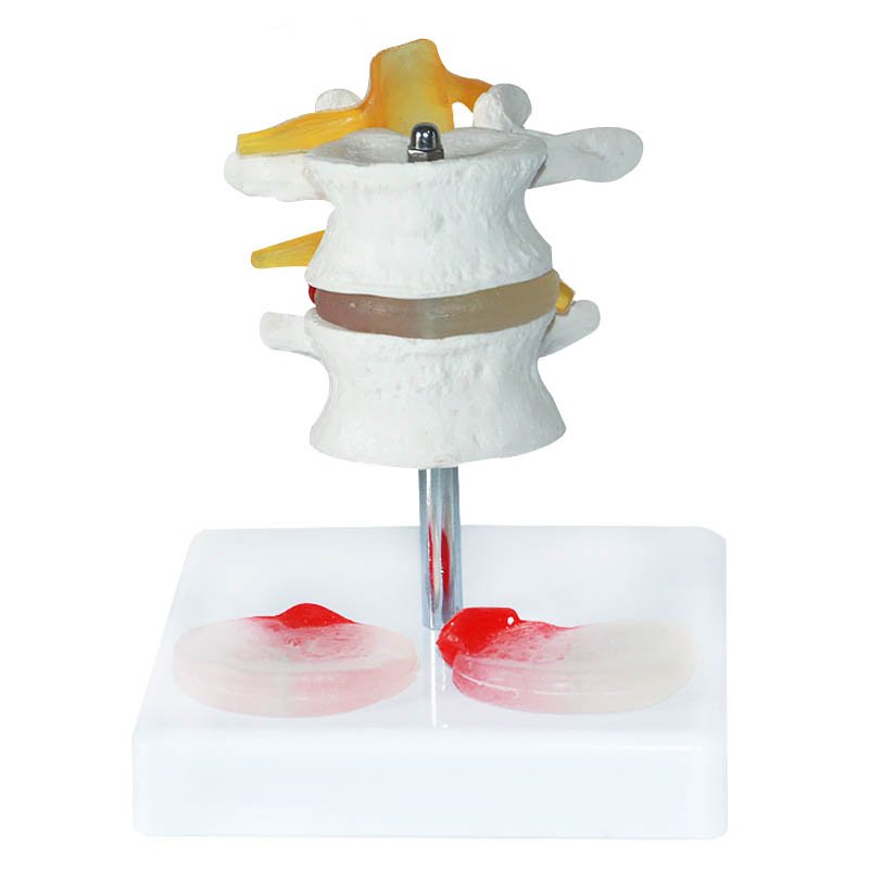 2 Section Human Lumbar Vertebra with Diseased Intervertebral Disc Model ...